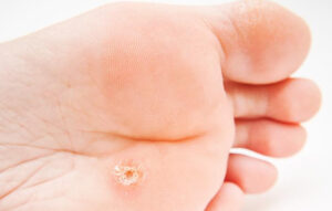 Wrat onder de voet | Oorzaken en behandeling